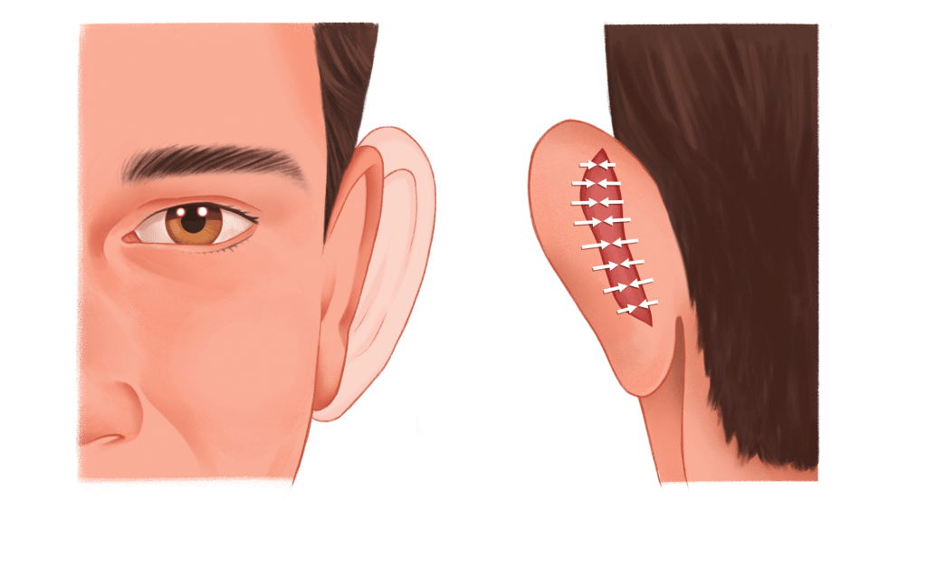Otoplastia | Clínica Fossati